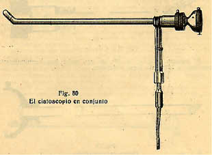 Como funciona el cistoscopio