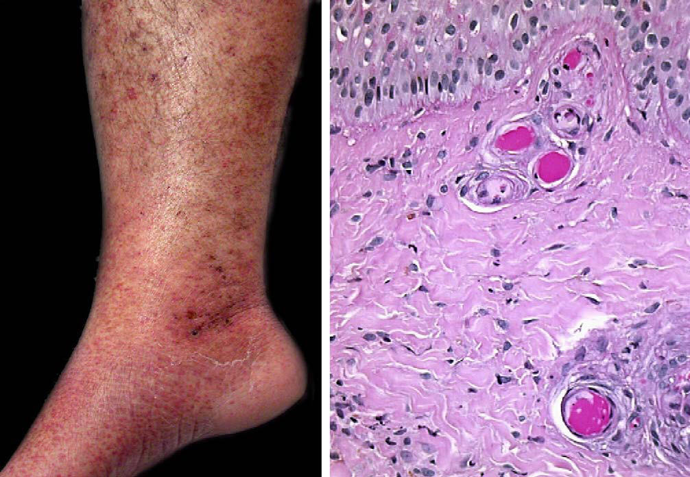 actitud diagnóstica ante la sospecha de vasculitis