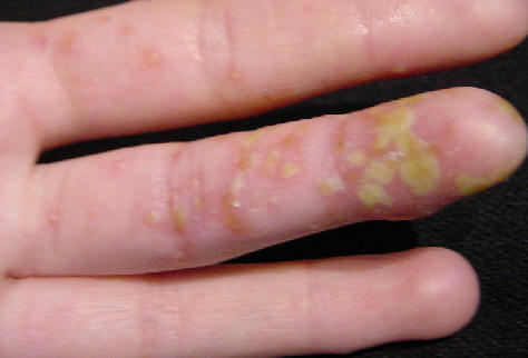 casos clínicos de dermatología. Dr. Victor Alegre. Universidad de Valencia