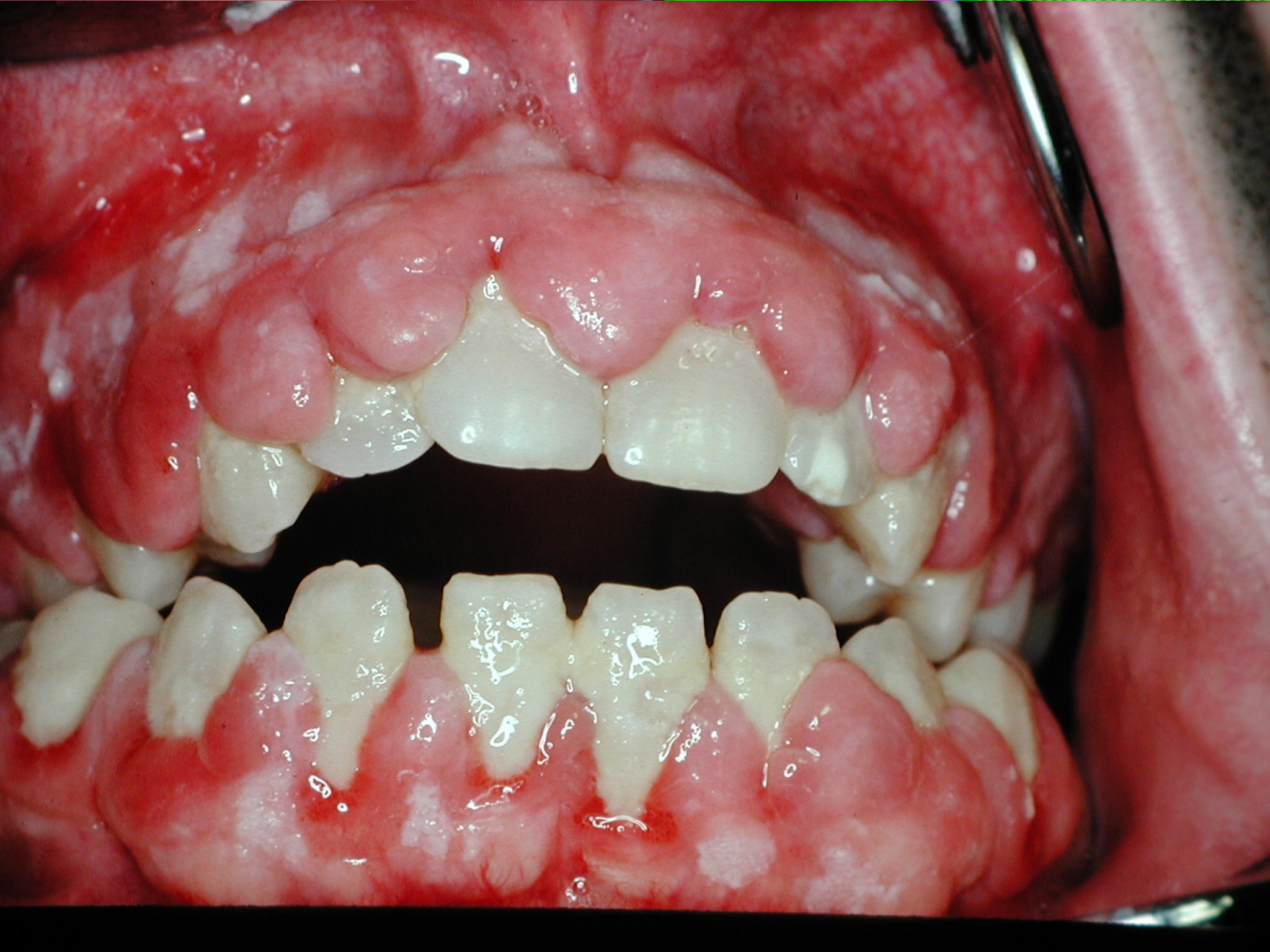 Hiperplasia gingival