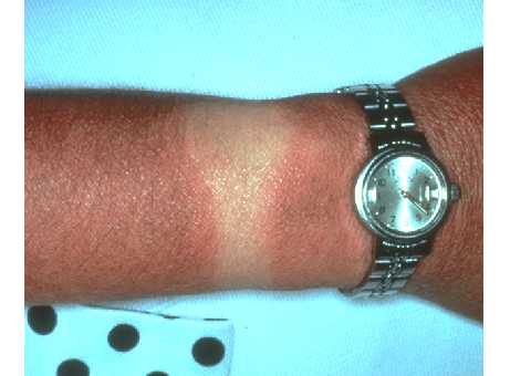 casos clínicos de dermatología. Dr. Victor Alegre. Universidad de Valencia