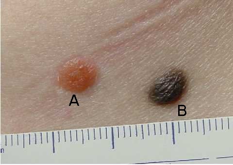 diagnóstico diferencial clínico de melanoma. www.uv.es/derma