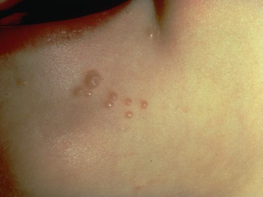 casos clínicos de dermatología. Dr. Victor Alegre. Universidad de Valencia